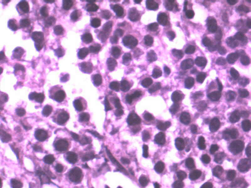 Angiodisplasia del Colon - El Atlas Gastrointestinal ...