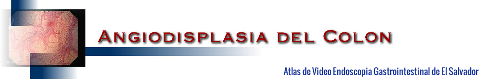 Angiodisplasia del Colon - El Atlas Gastrointestinal ...